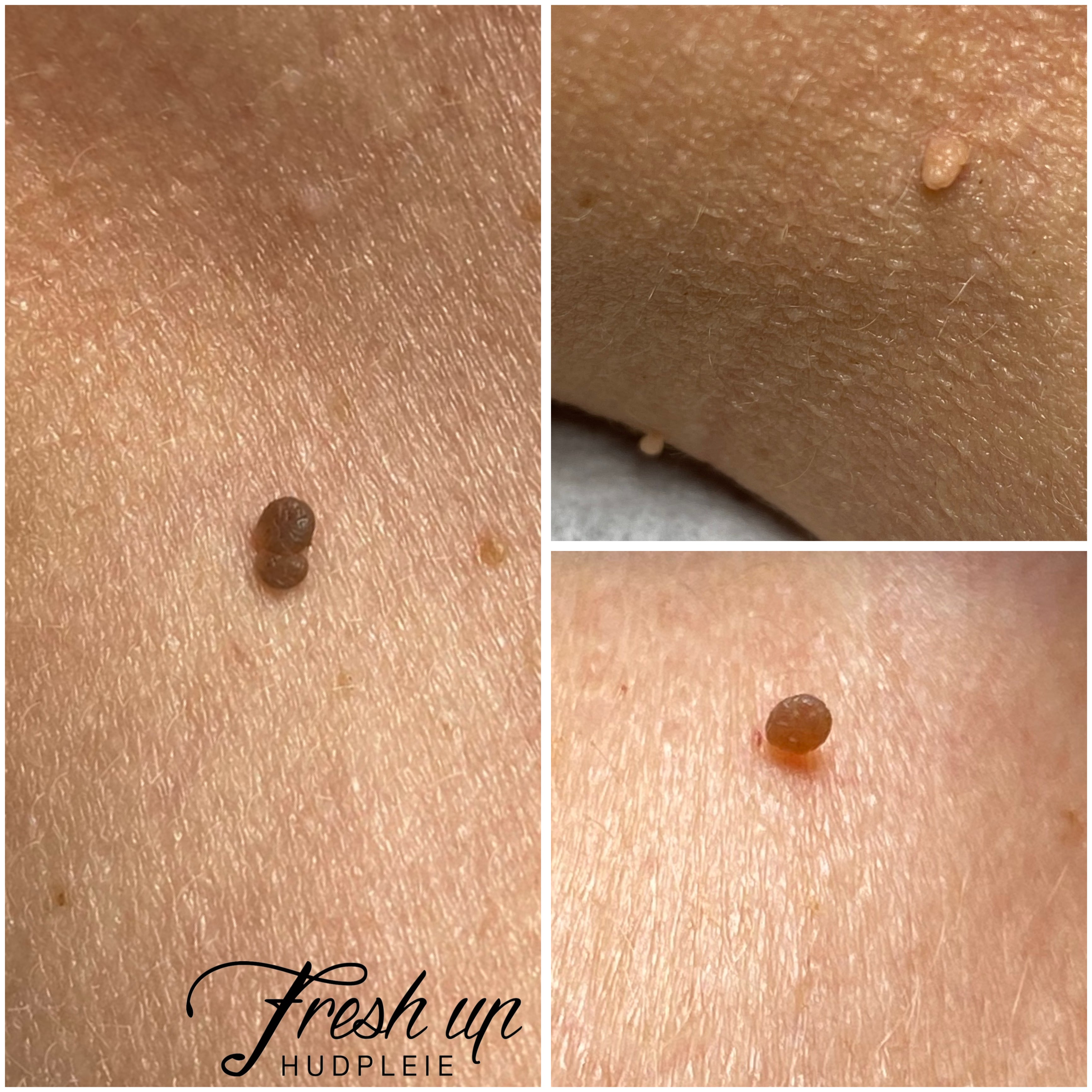Skin-Tags og stilkvorter – Fresh Up Hudpleie